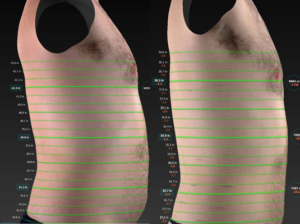 Body Contouring Cost | Body Beautiful MiamiElite Body Contouring